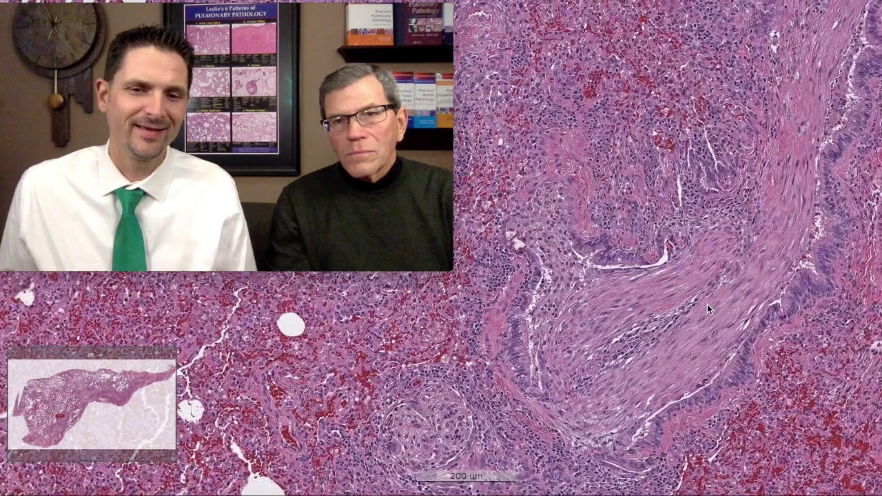 Pattern 1 Acute Lung Injury – The Pathology of Vaping Associated Lung ...