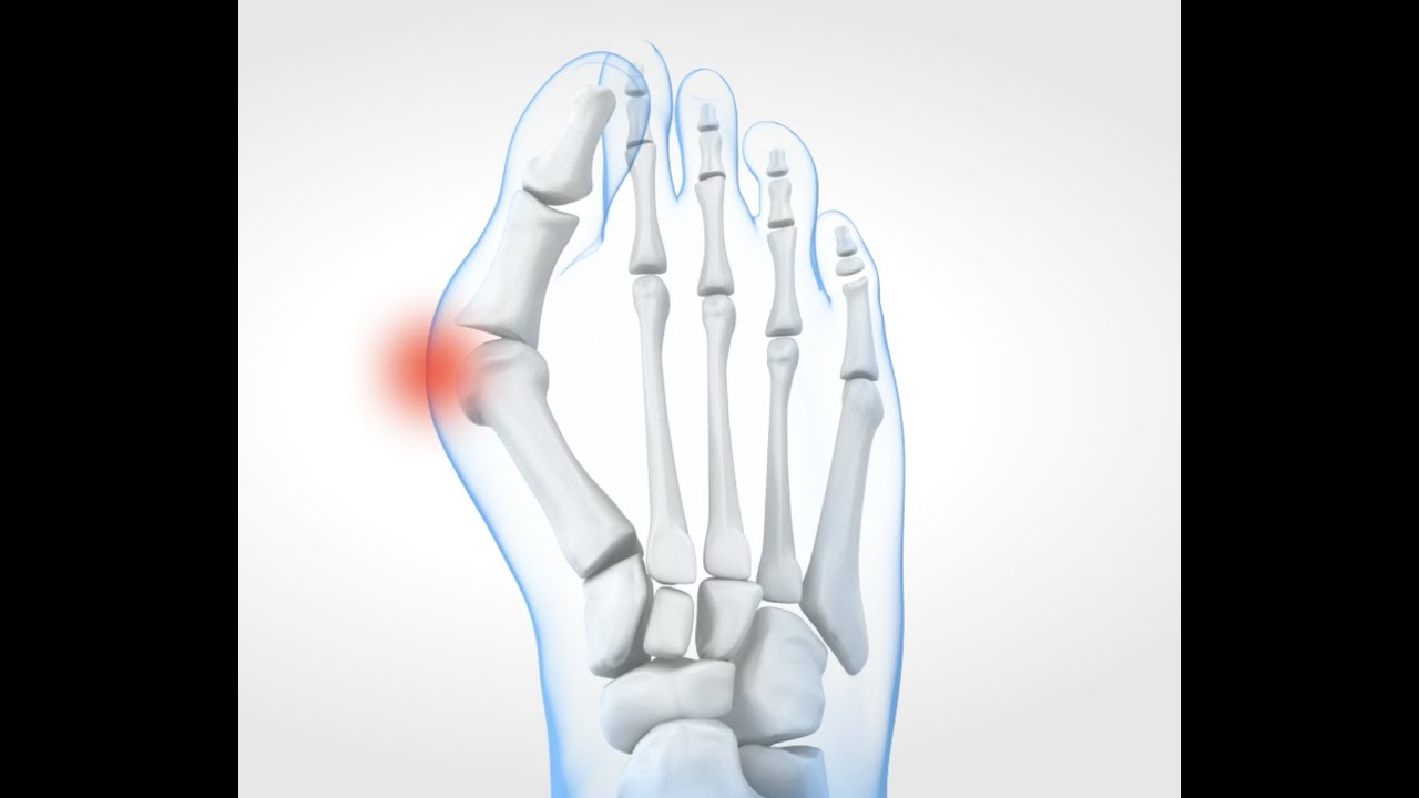 Hallux Valgus : Animation 3D sur la Technique Mini-invasive et ...