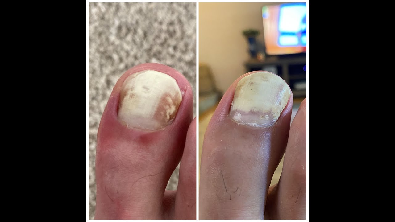 SMASHED and BLOODY TOE NAIL REMOVAL - YouTube