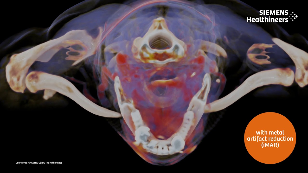 Siemens Healthineers : iterative Metal Artifact Reduction (iMAR) - YouTube