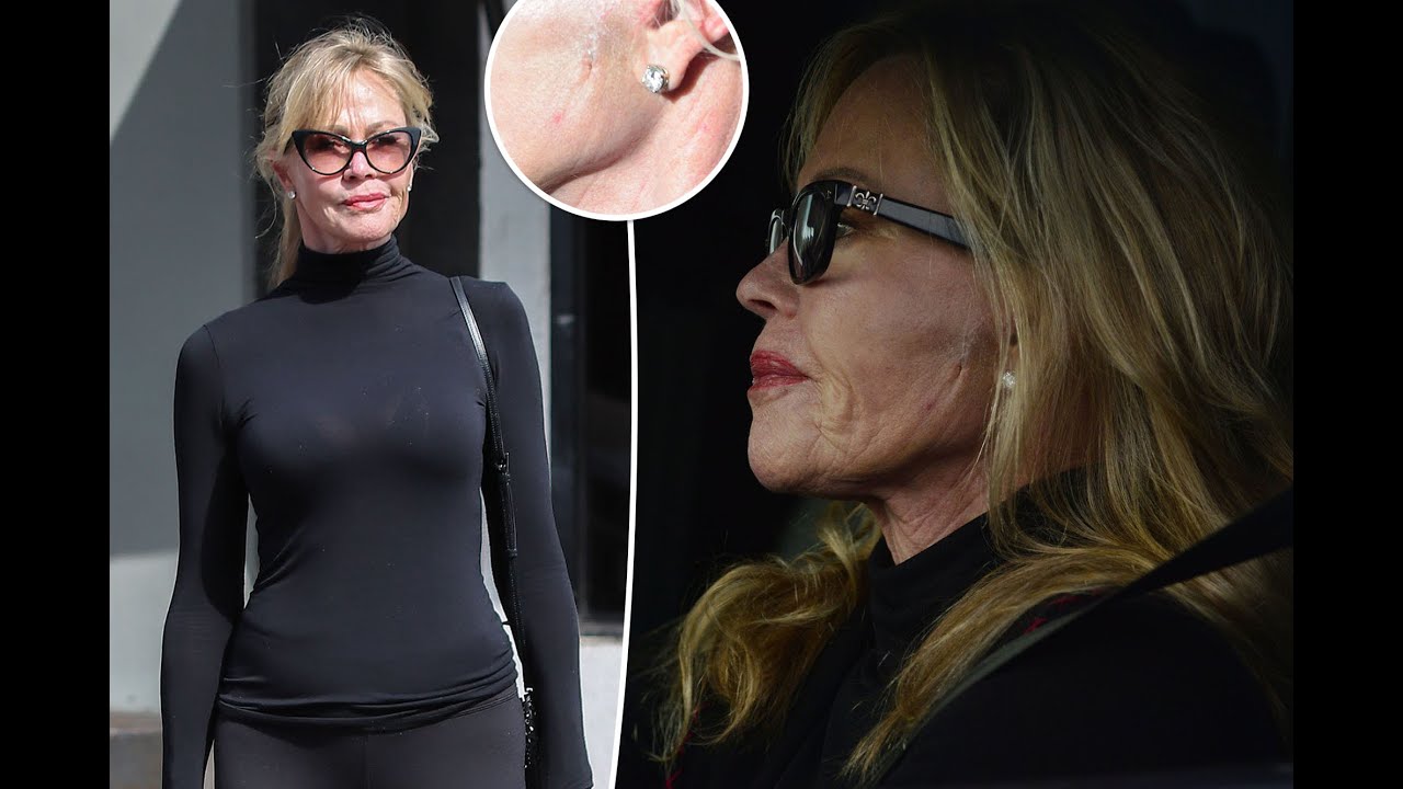 Melanie Griffith seen with new scar on her face years after skin cancer ...