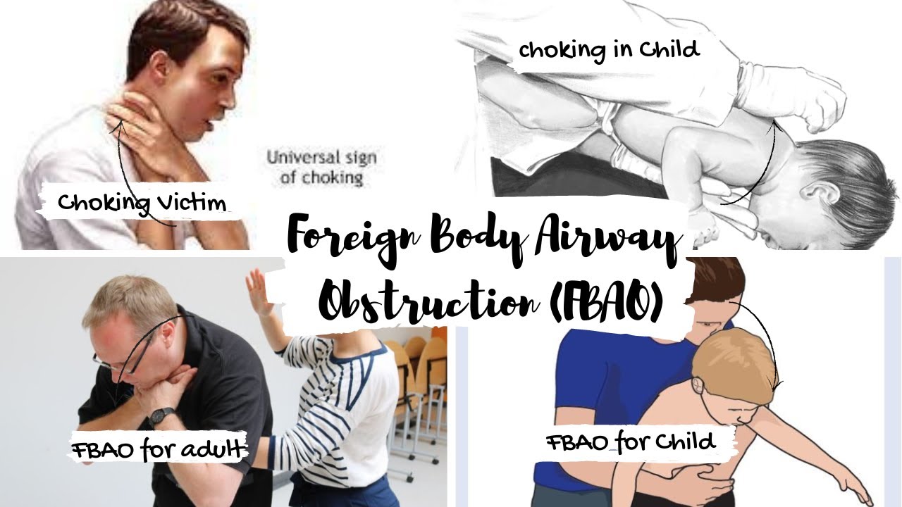 Foreign Body Airway Obstruction (FBAO) for Adult - Adult choking - YouTube