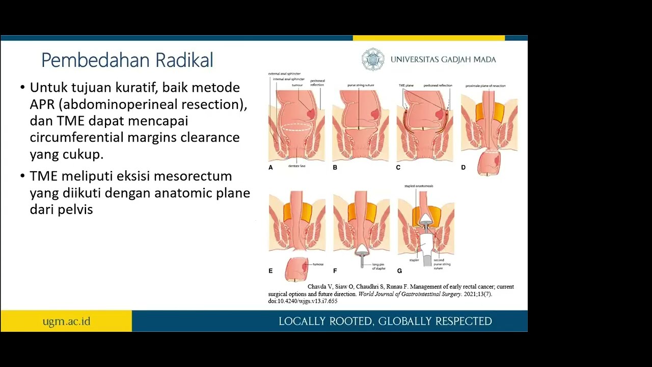 Terapi Multidisiplin Kanker Rektum - YouTube