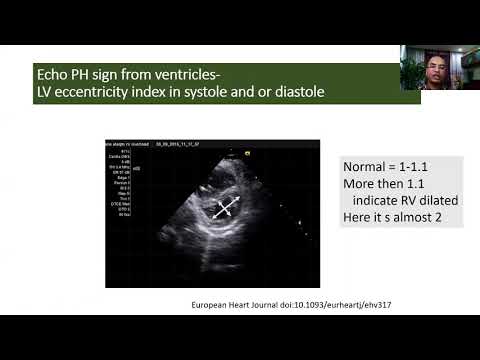 Philips Echo Webinar Series Echocardiographic Assessment in Pulmonary ...