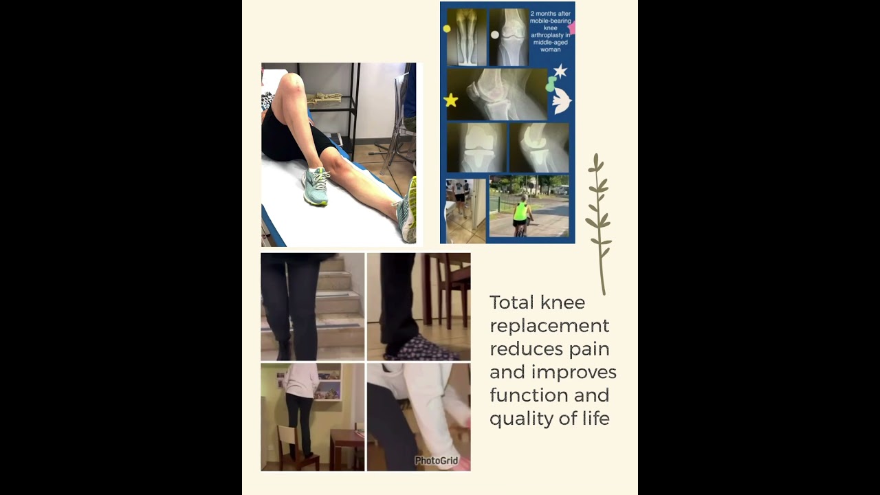 Total knee arthroplasty (TKA) reduces pain and improves function and ...