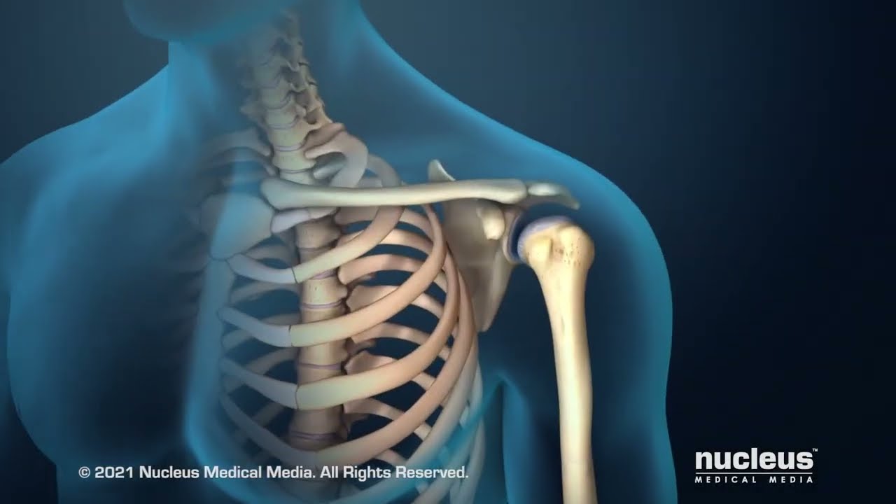 Shoulder Arthritis Pain - YouTube