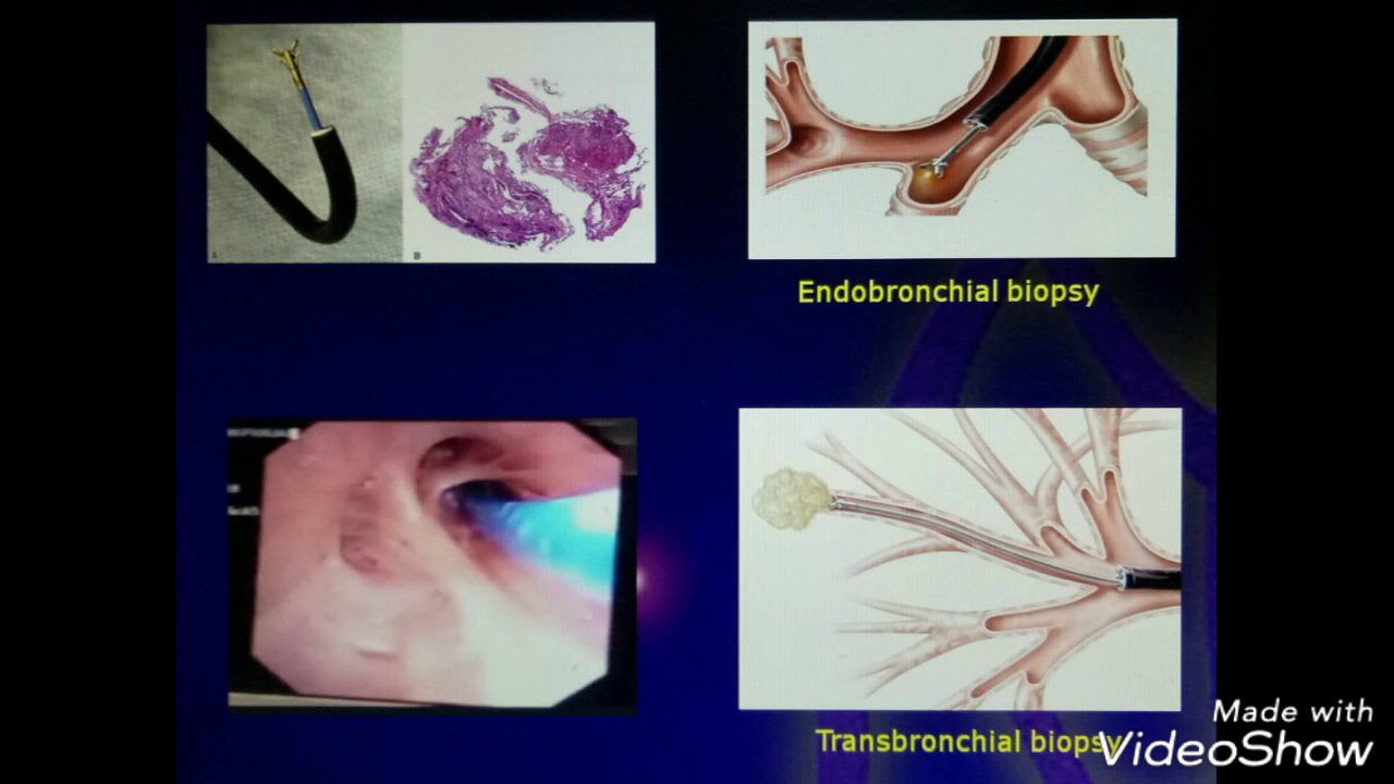 Transbronchial Lung Biopsy (TBLB / TBBx) - YouTube