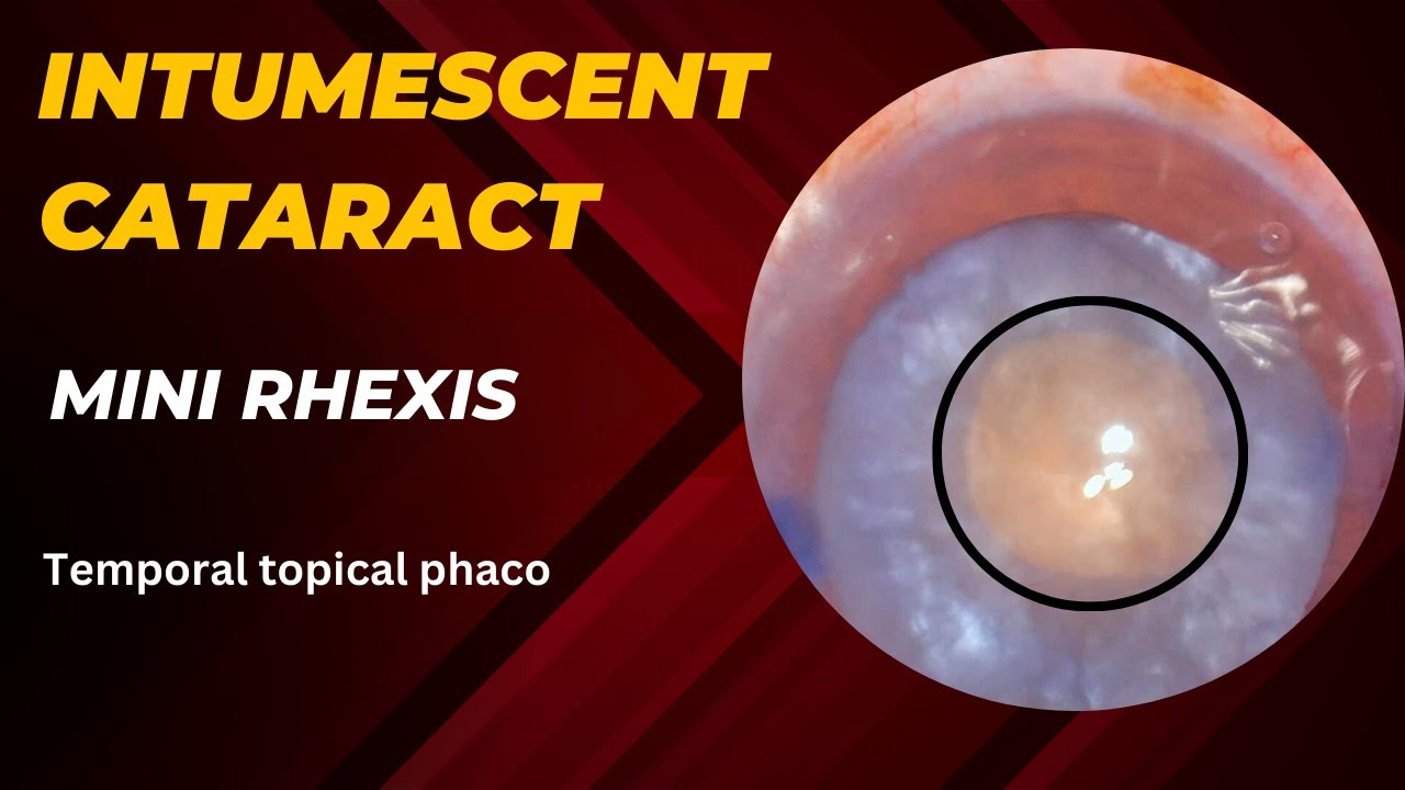 Case series 89. Intumescent cataract made easy! Mini Rhexis the way to ...