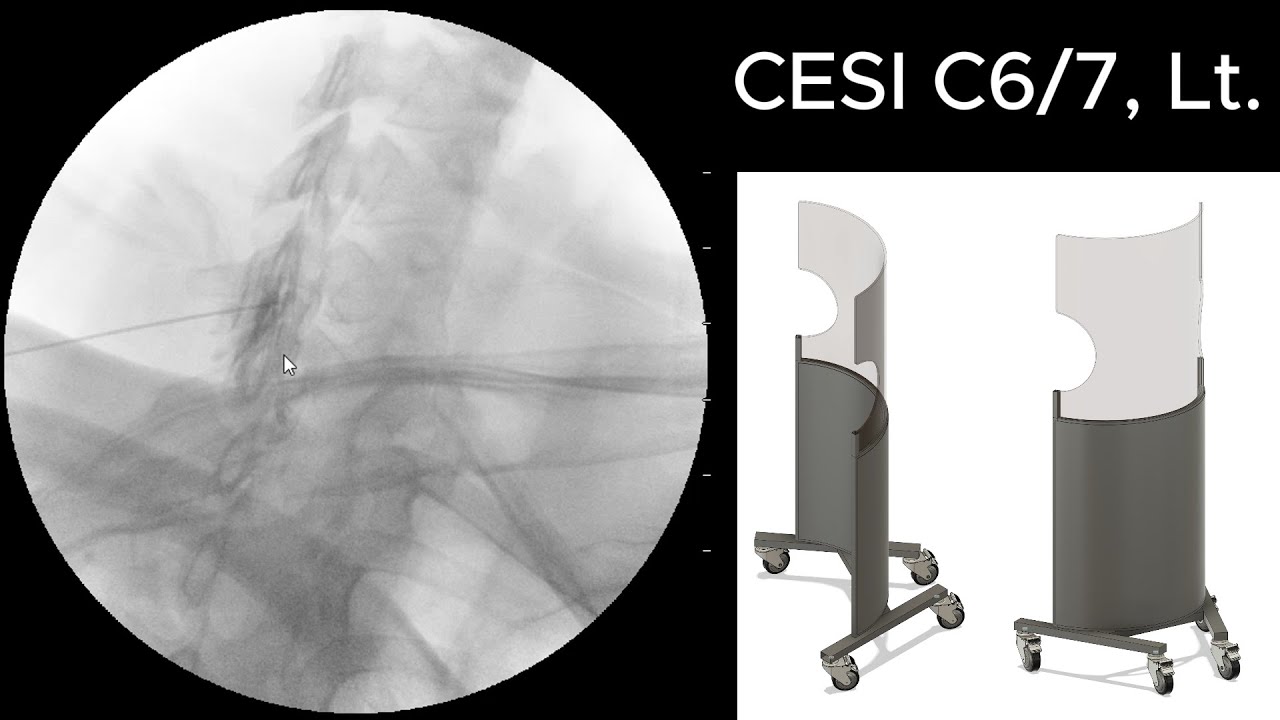 CESI 정확하게 하는 방법 (5) Cervical epidural steroid injection - YouTube