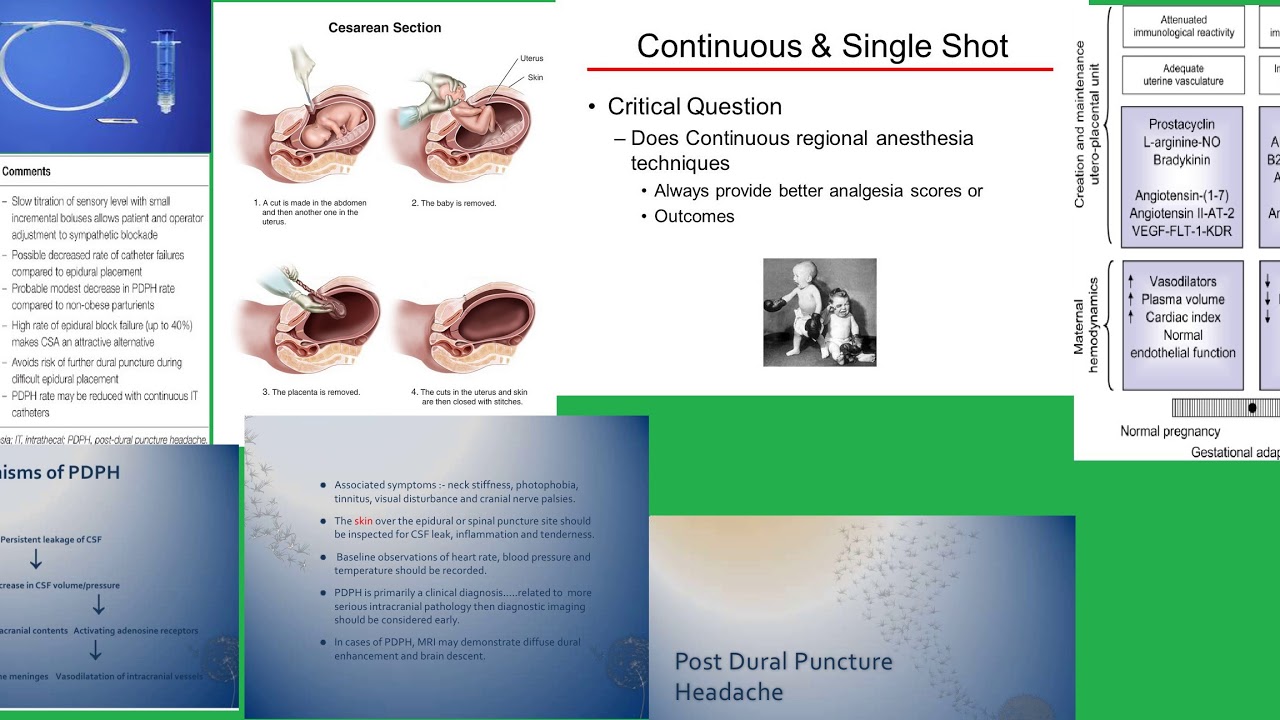Single shot and continuous spinal anesthesia using epidural kit for ...