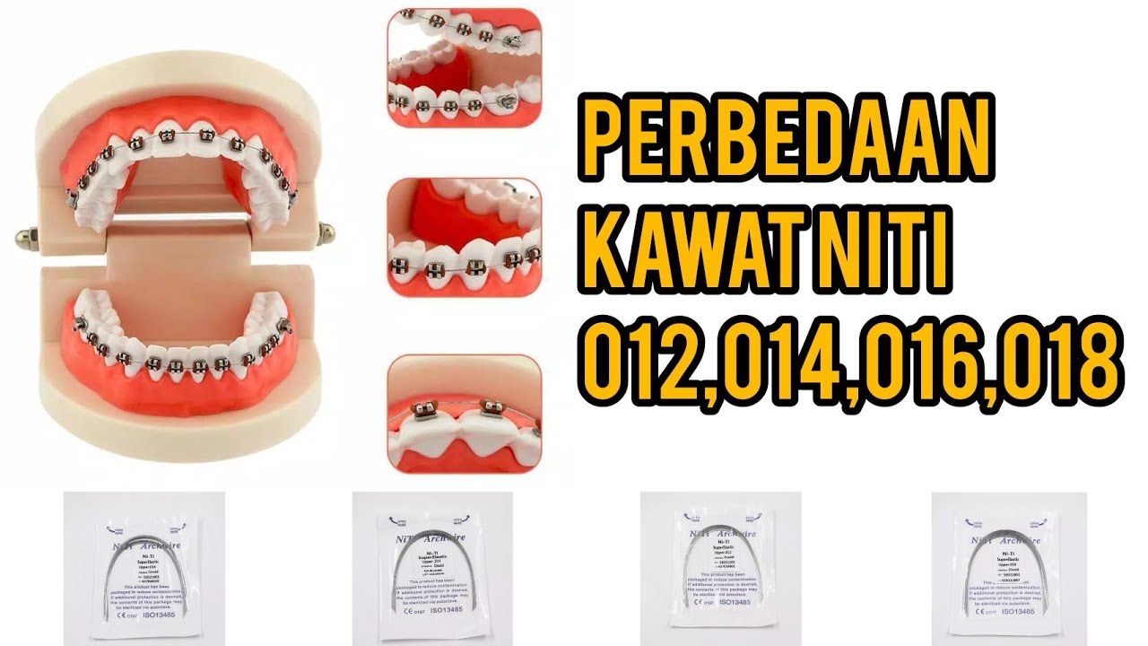 Perbedaan dan jenis kawat perawatan behel gigi yang perlu diketahui ...