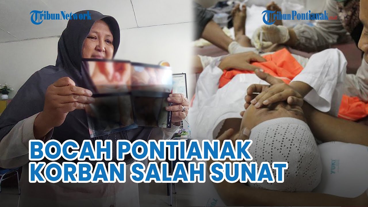 🔴 Diduga Salah Prosedur Saat Sunat, Bocah di Pontianak Harus Operasi ...