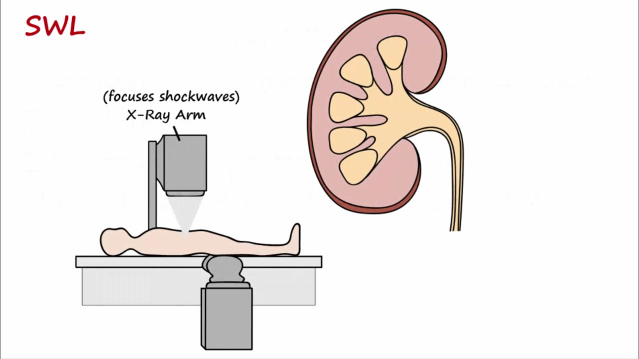 Kidney Stones - Types, Formation, Treatment, Prevention - YouTube