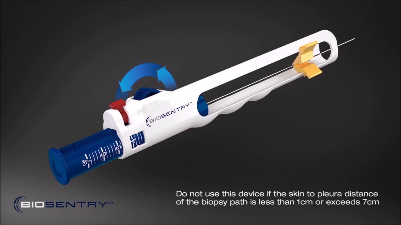 BioSentry™ tract sealant system - YouTube