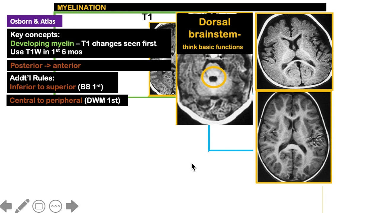 Myelination in MRI (4/4)- simplified - YouTube