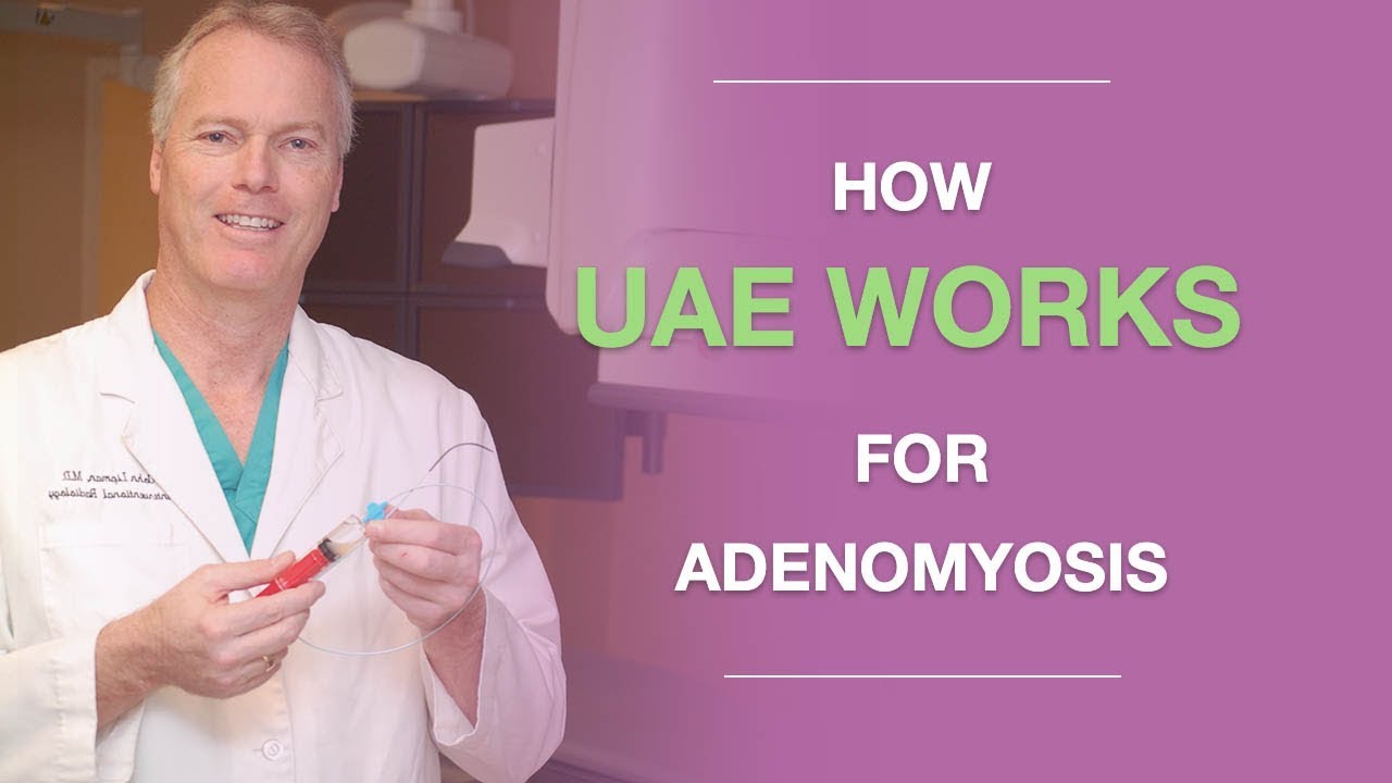 How Uterine Artery Embolization (UAE) Works for Adenomyosis - YouTube