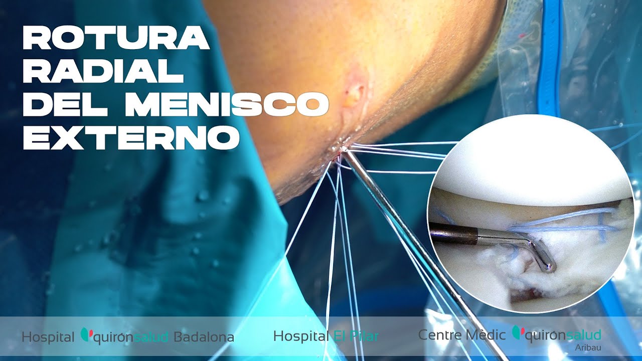 ROTURA RADIAL DE MENISCO EXTERNO (Radial external meniscus tear HASTAG ...