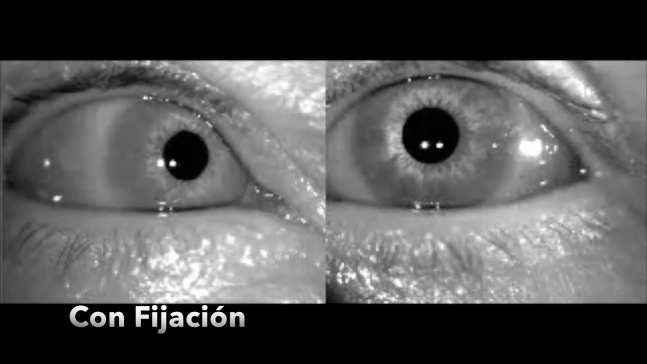 spontaneous-upbeating-nystagmus-youtube