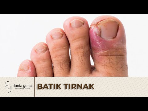 Batık Tırnak Tedavisi - Deniz Yahcı