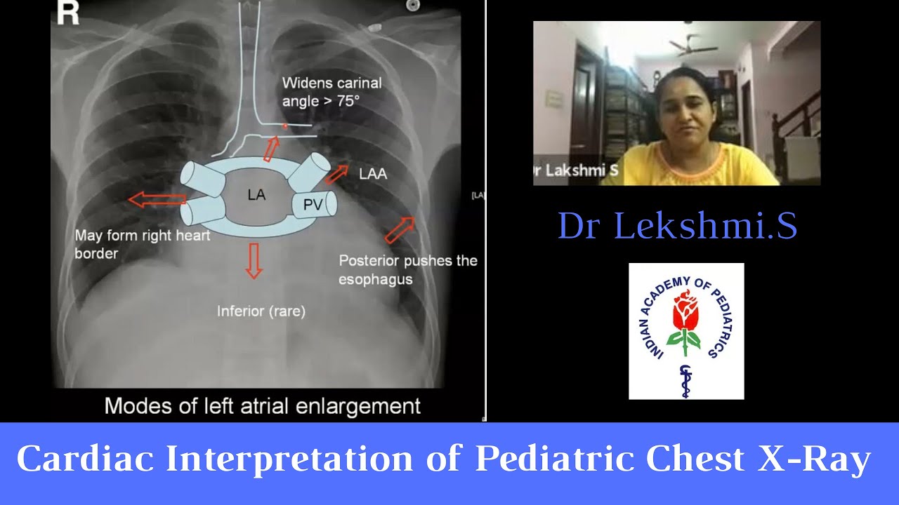 Chest X-ray- Focusing the CVS - Cardiac Interpretation of Pediatric ...