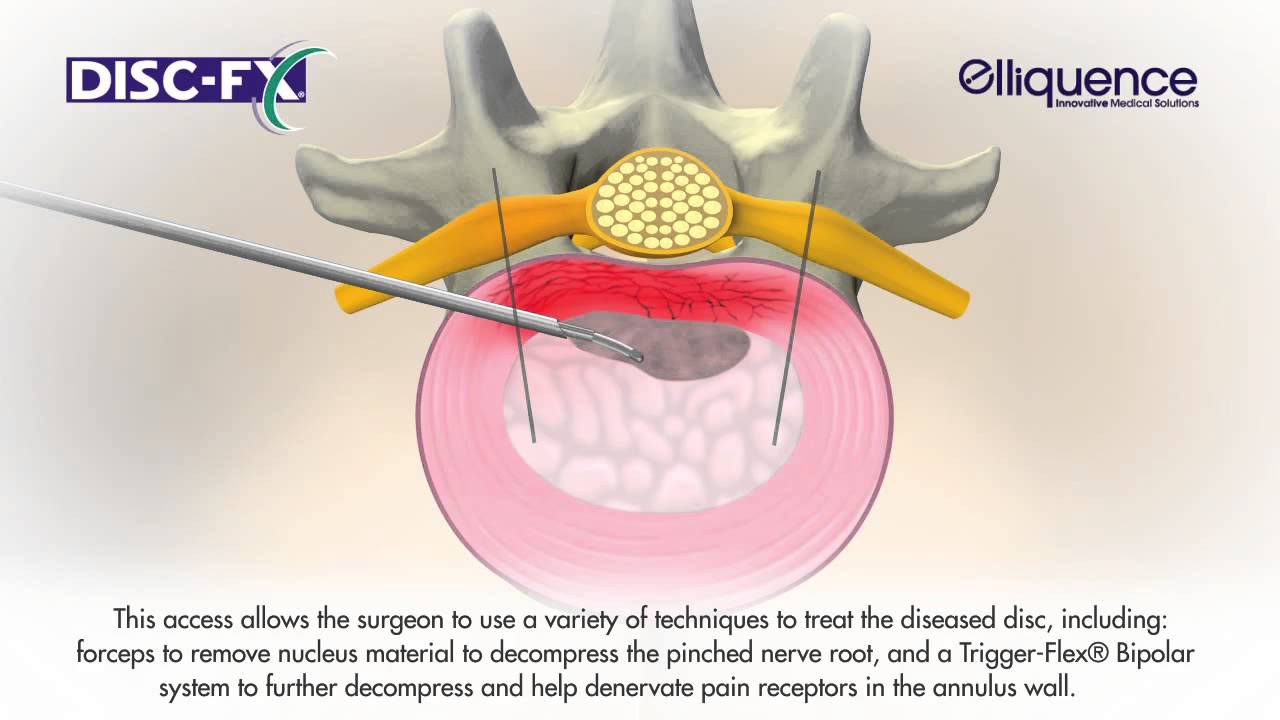 DiscFX minimal invasive microtubular discectomy system Disc FX / DFX ...