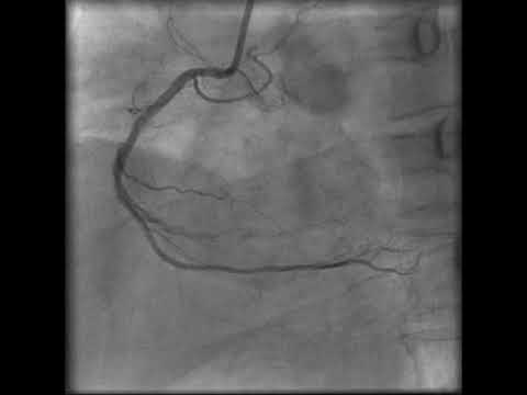 coronary angiogram - YouTube