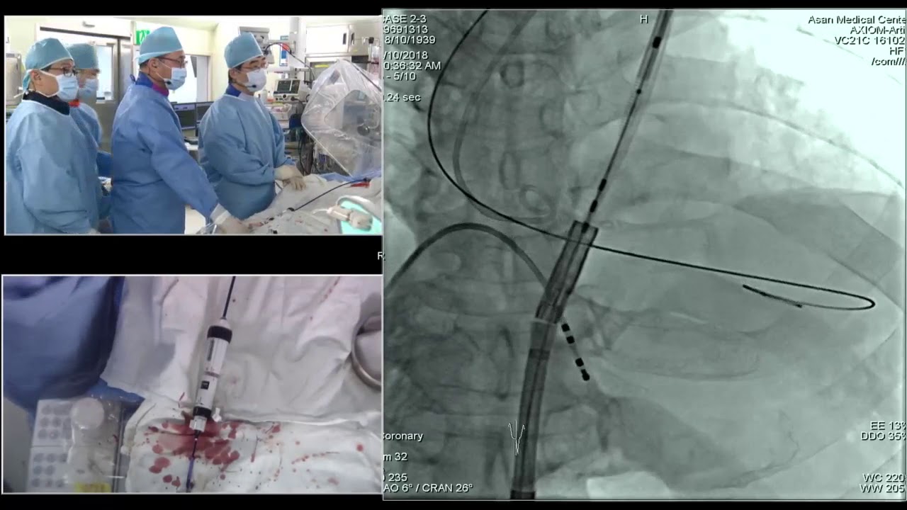 [AP VALVES 2018] Live Case II - YouTube