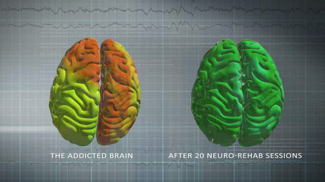 The Florida House: NeuroFeedback Training Program for Addiction ...