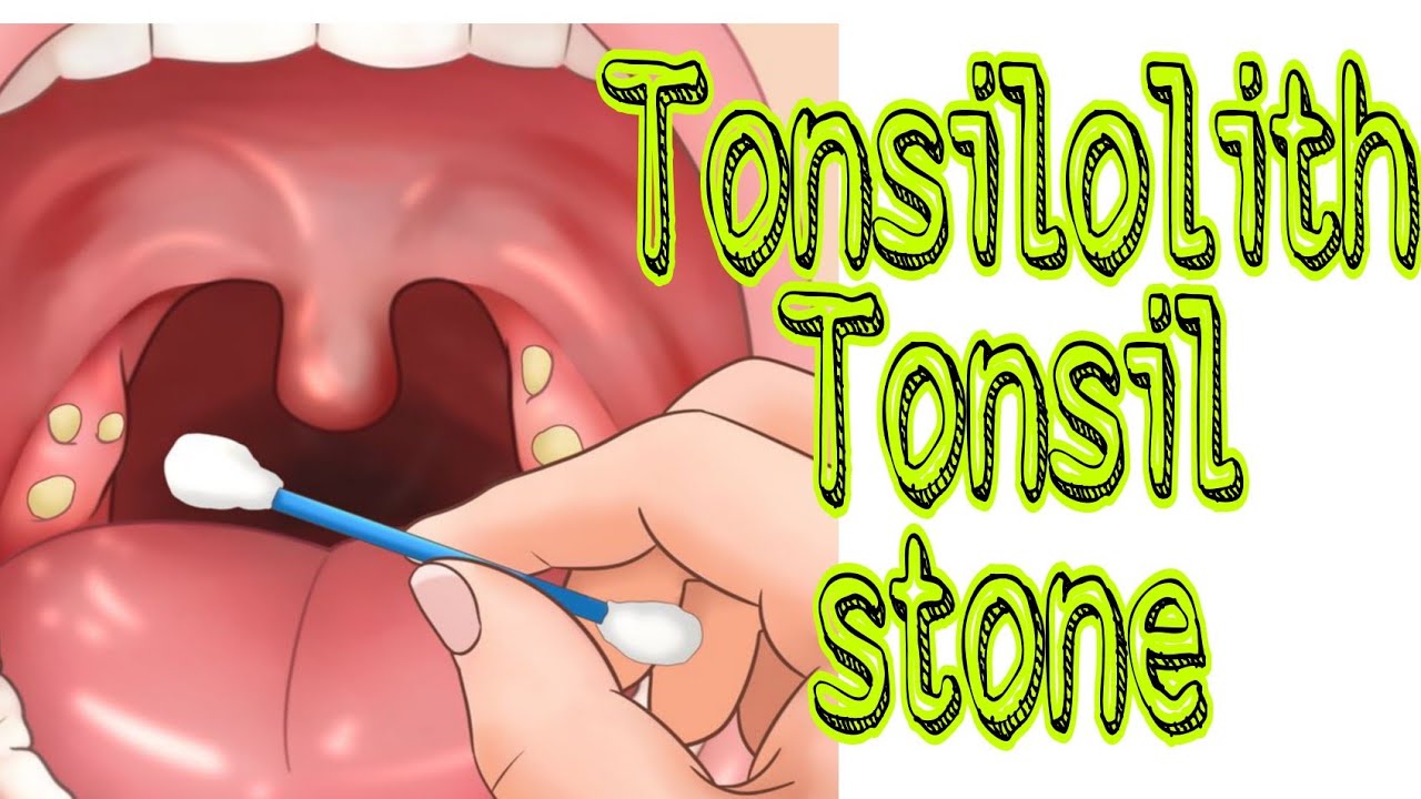 Tonsillolith Tonsil stone removal - YouTube