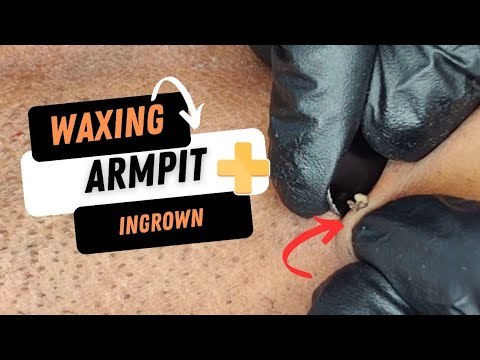 Waxing armpit &  Ingrown Hair Removal PART 1