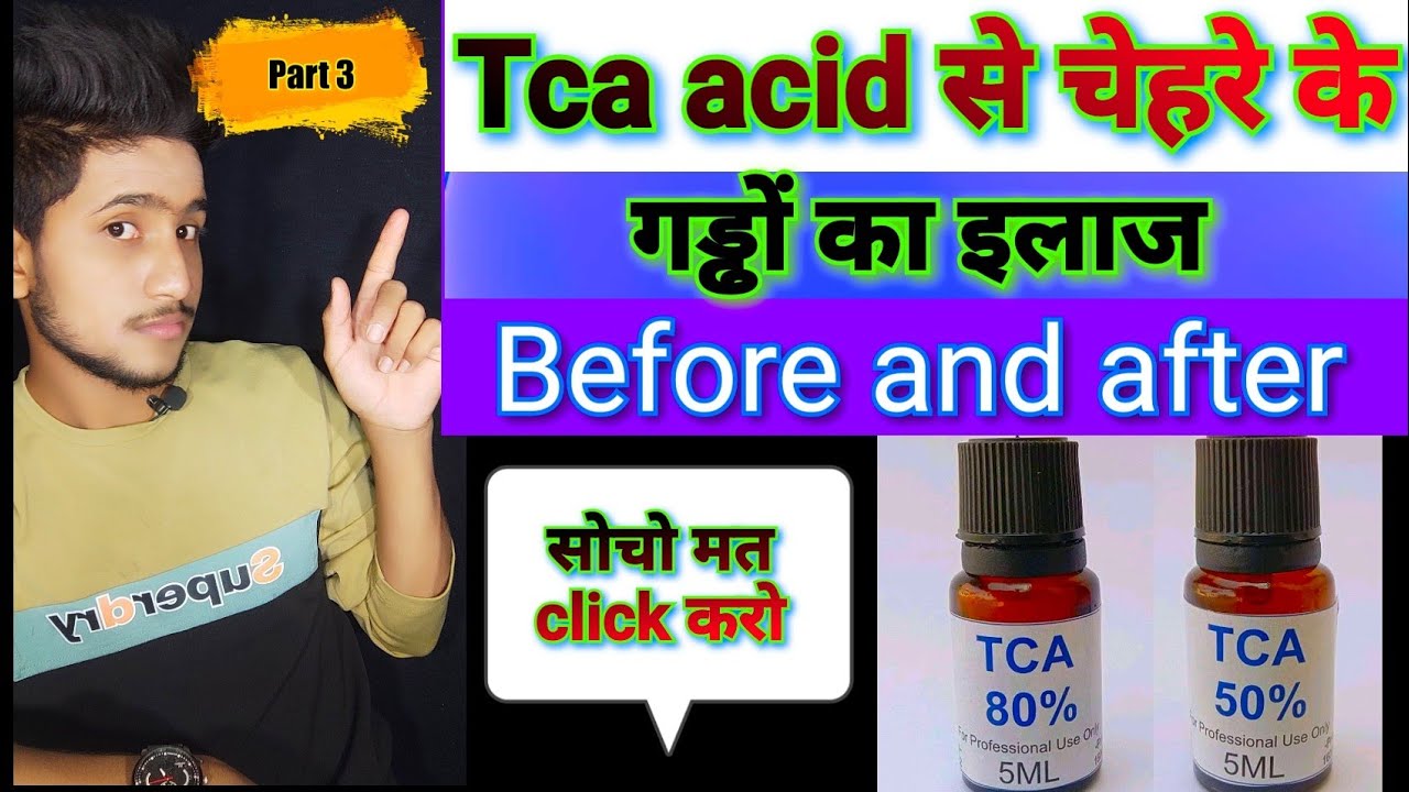 Tca acid se chehre ke gadde ka ilaj | Tca cross 80 percent before and ...