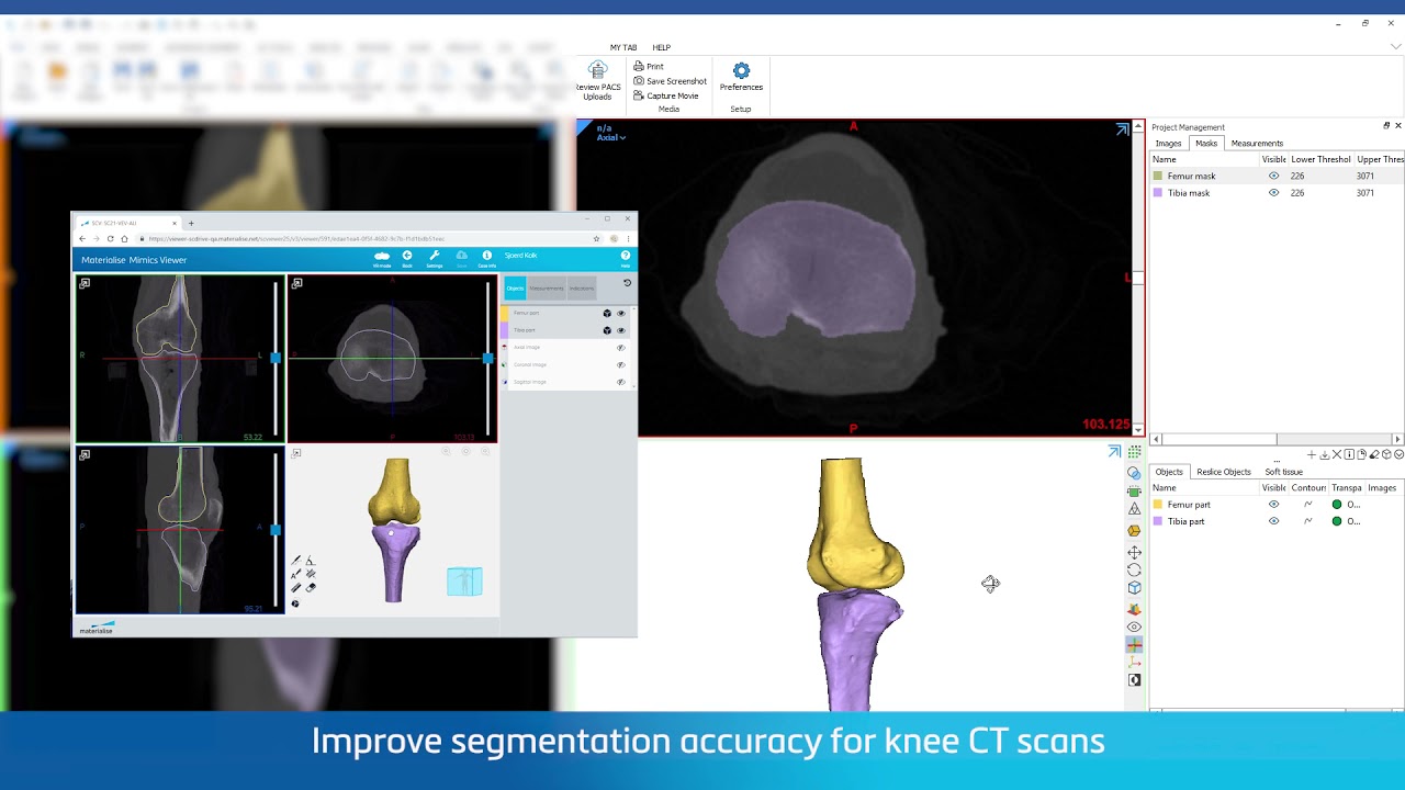 AI-Enabled Automatic Knee CT Segmentation | Mimics Innovation Suite 24 ...