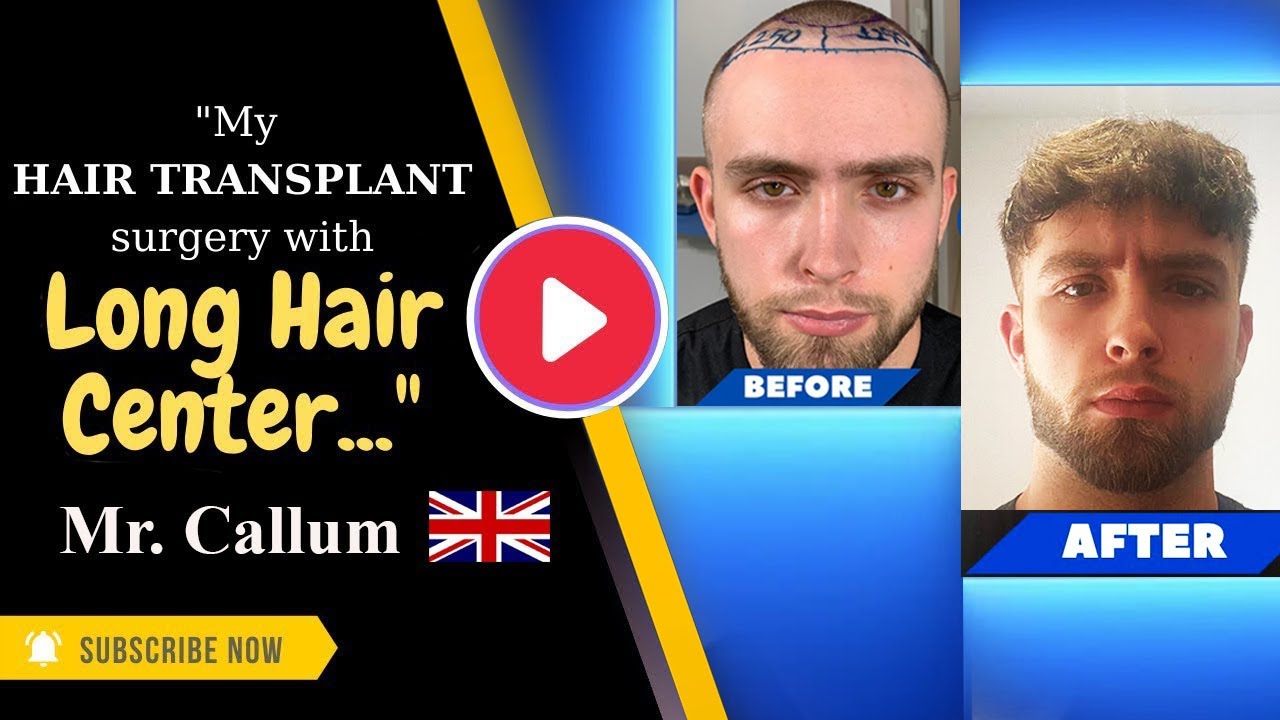 Mr. Callum's first choice for his hair transplant: Long Hair Center. ll ...