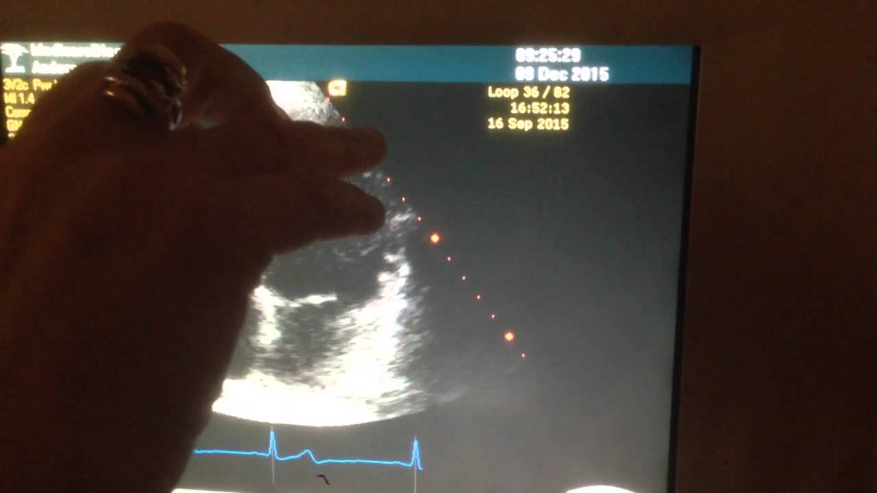 Protocoll_Echo_from PSAX Pulmonary - YouTube