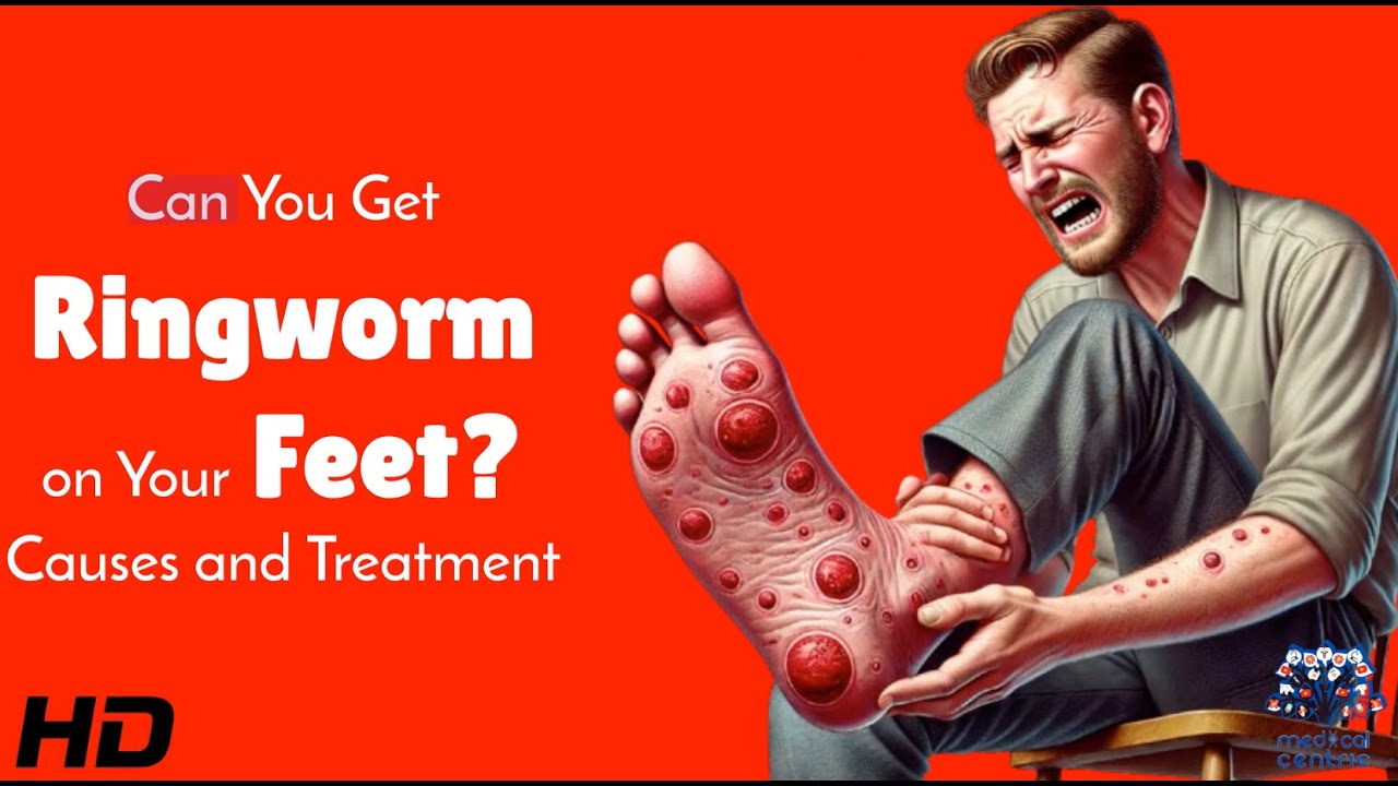 Ringworm on Your Feet? Here's What You Need to Know! - YouTube