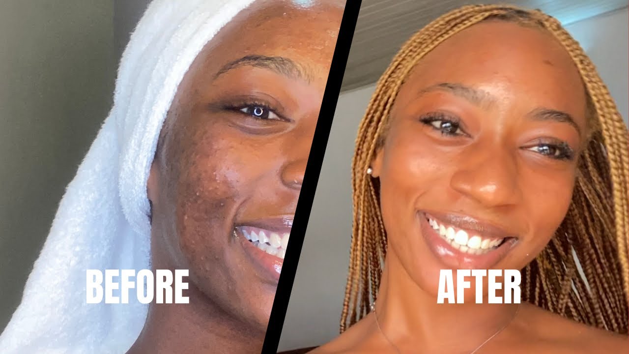 Skin care transformation: DOVE soap transformation in 2-3 weeks - YouTube