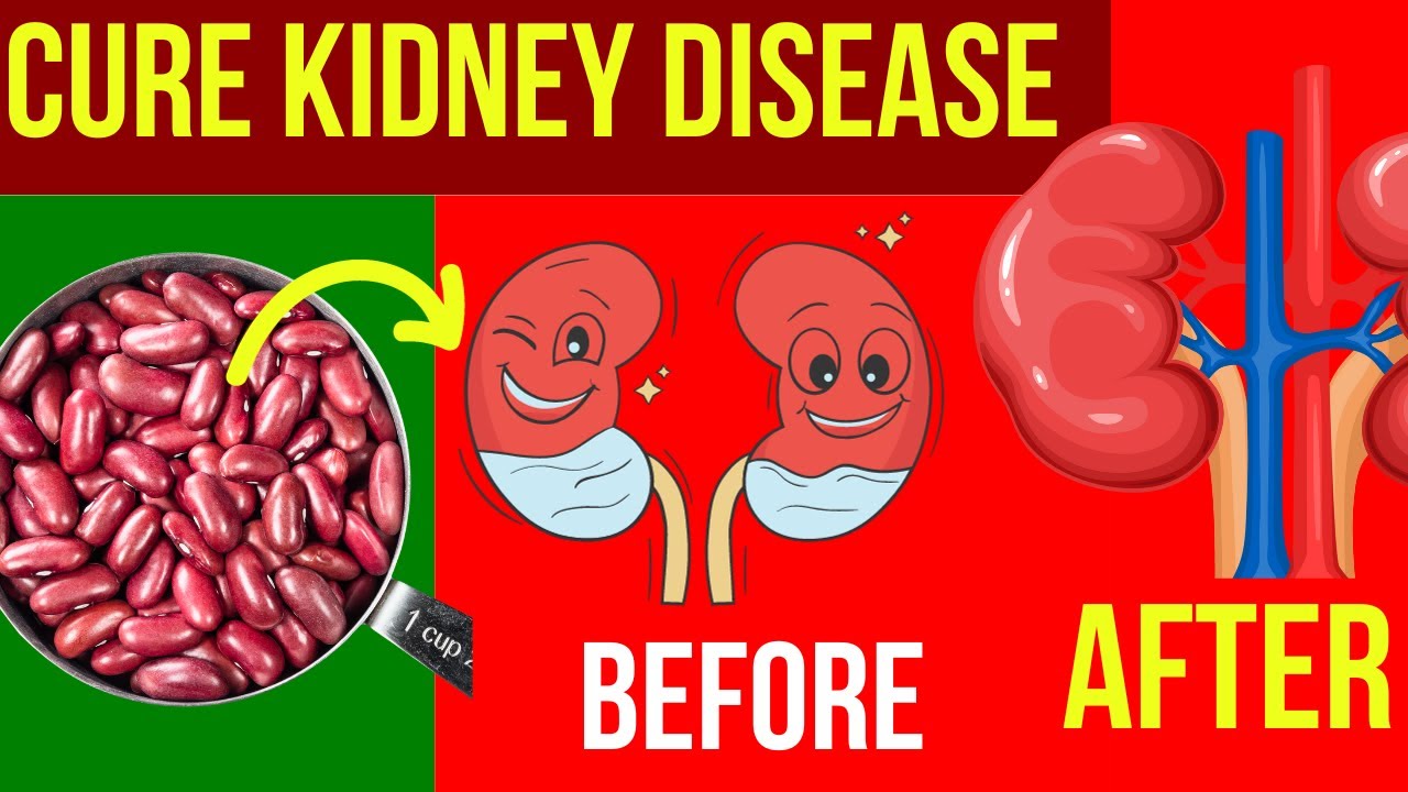 DO THIS! No Kidney Patient Will Ever Lose a Kidney Again | Pure - YouTube