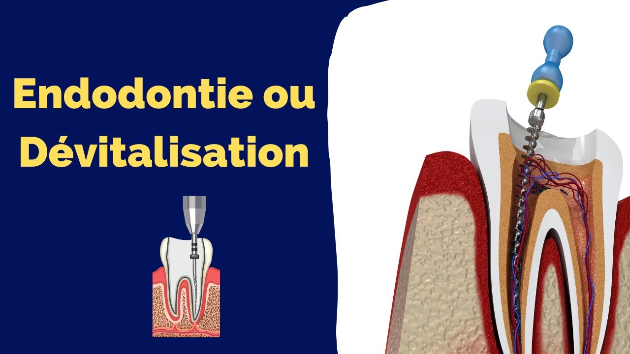 Endodontie ou dévitalisation dentaire que est ce que c'est - YouTube