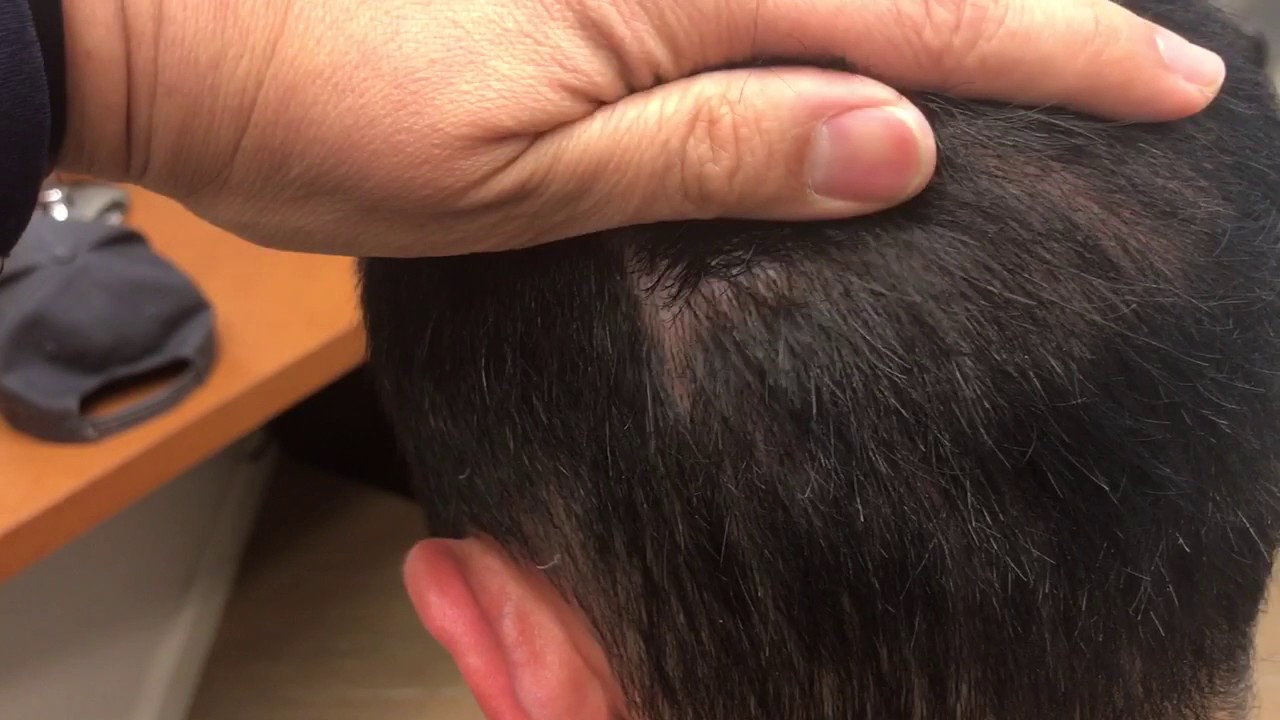 Asian Early View of Trichophytic Incision with Short Hair - YouTube