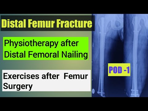 Physiotherapy after Femur surgery.physio after Proximal Femoral Nailing ...