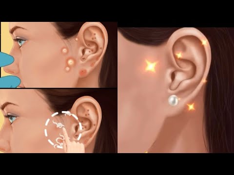 Asmr What causes blackheads and pimples in ears|| - YouTube