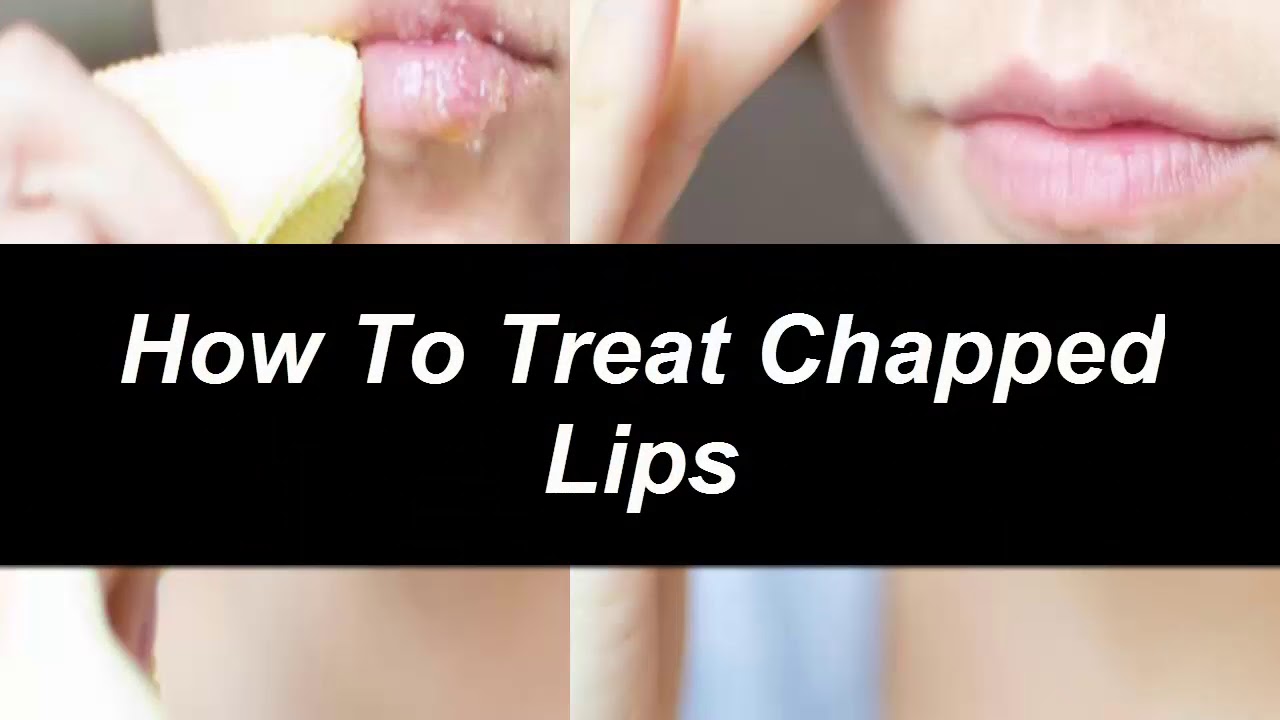 How To Get Rid of Chapped Lips Forever - YouTube