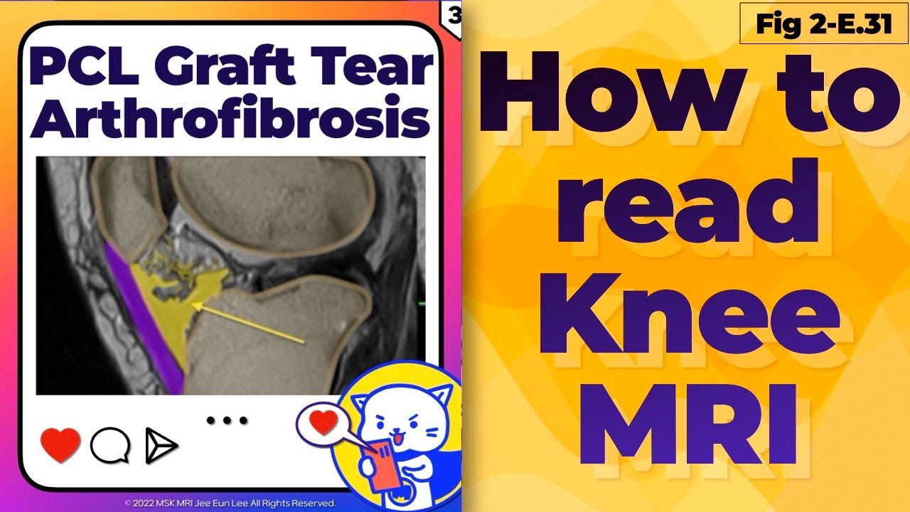 (Fig 2-E.31) Graft Tear In PCL Reconstruction and Arthrofibrosis - YouTube