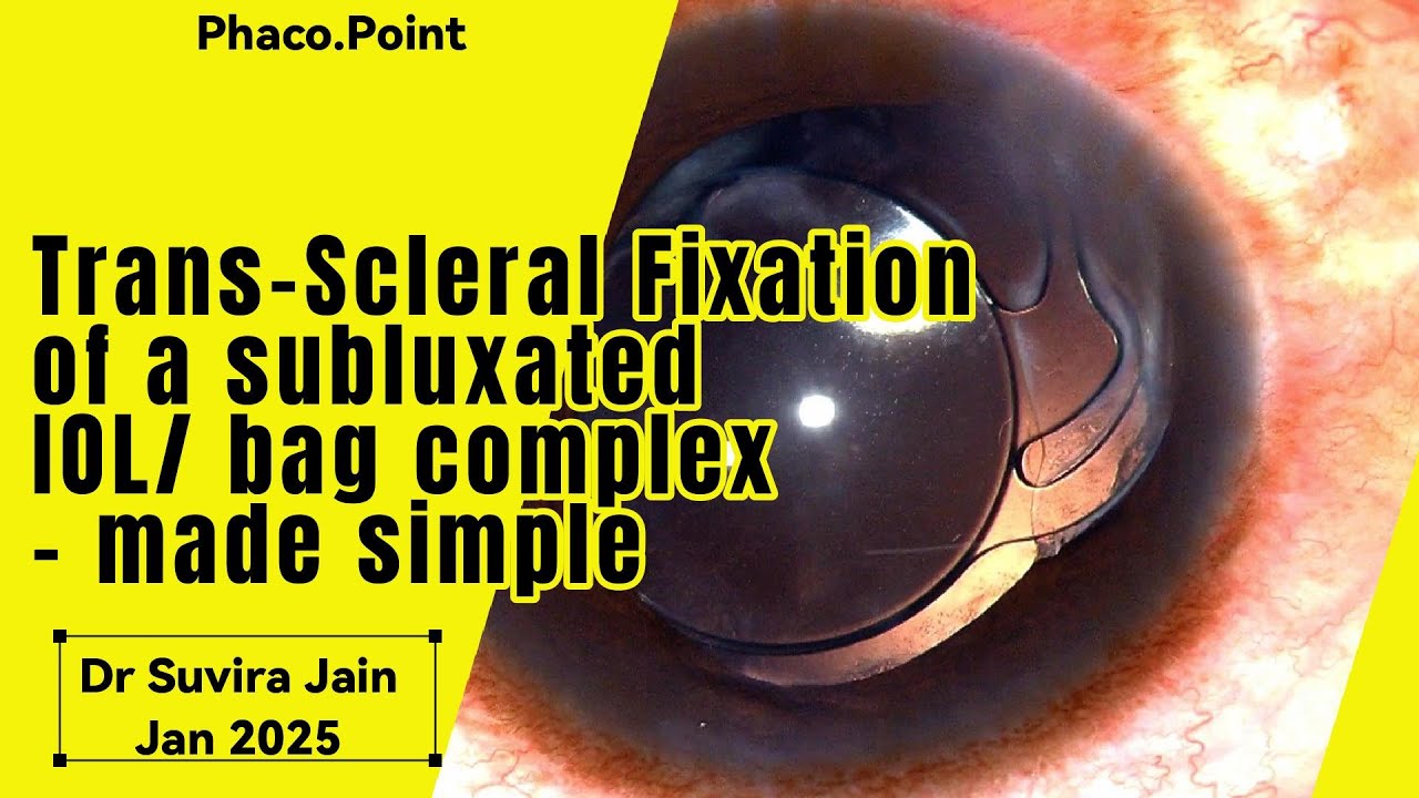 Trans-Scleral Fixation of the Subluxated IOL/Bag complex - Made Simple ...