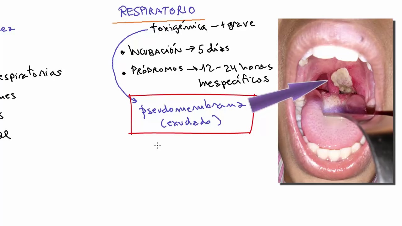 Difteria: Causas, Fisiopatología, Síntomas, Factores De Riesgo – RUAUE