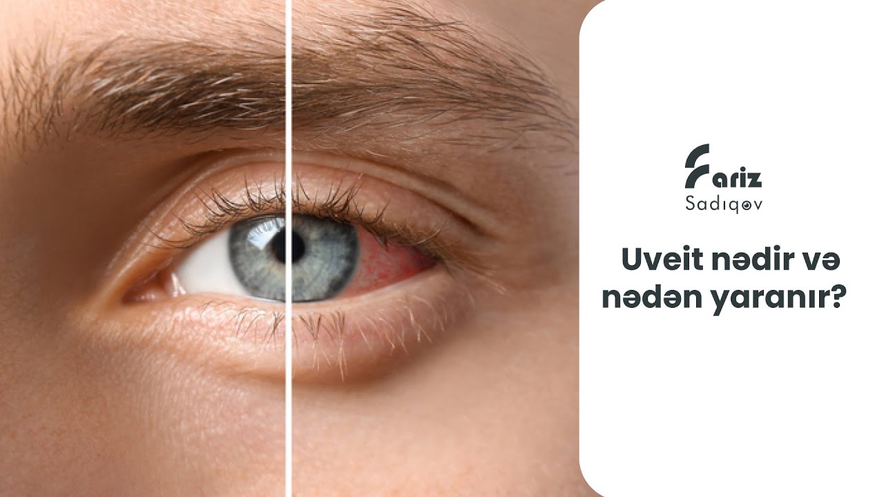 Uveit nədir və nədən yaranır? | #gözhəkimi #gözxəstəlikləri #göz # ...