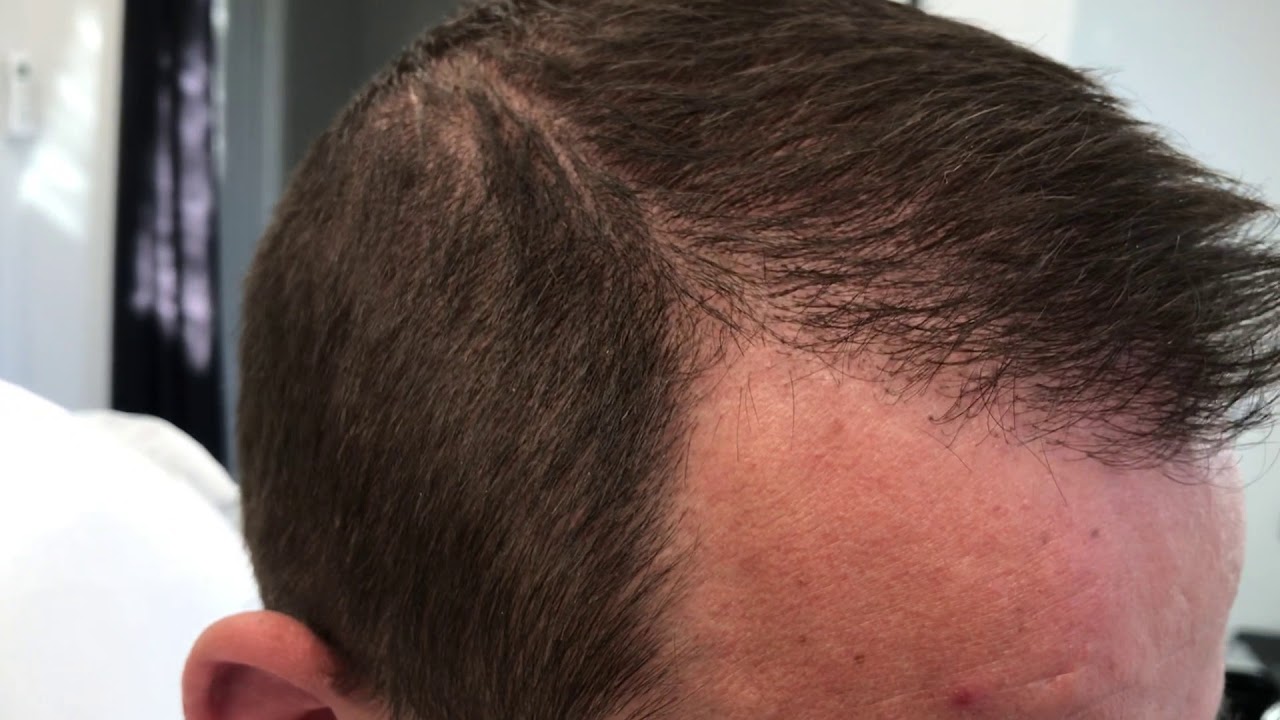 1706 GRAFTS - 4741 HAIR - YouTube