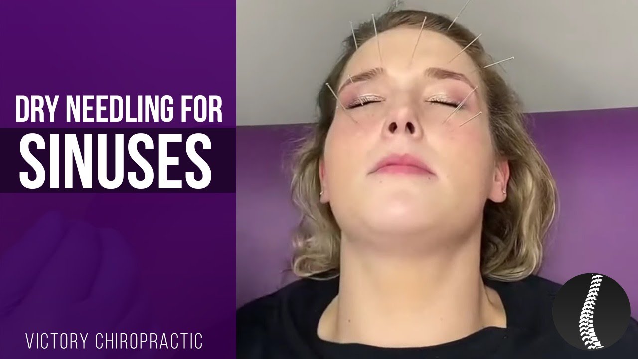 UPPER CERVICAL ADJUSTMENT & DRY NEEDLING FOR SINUSES Frankfort ...