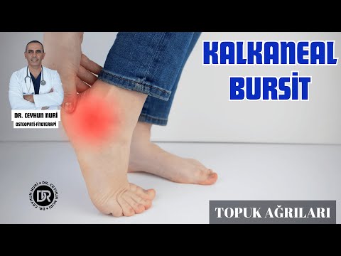 Kalkaneal Bursit Nedir? #topuk #ayak#kalkanealbursit #teoria