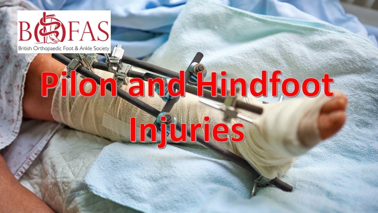 Management of Pilon and Hindfoot Injuries - YouTube